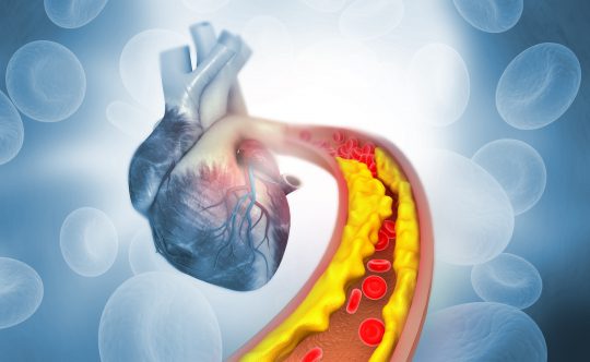 Hypercholesterolemia: Causes, Diagnosis & Treatment Options